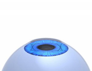 Visian ICL Treatments at Eye Center of Northern Colorado